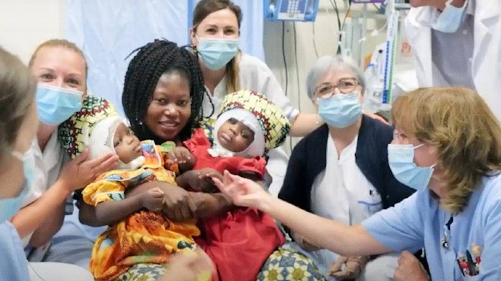 Doctor Shares Story Of Conjoined Craniopagus Twins & It's Amazing