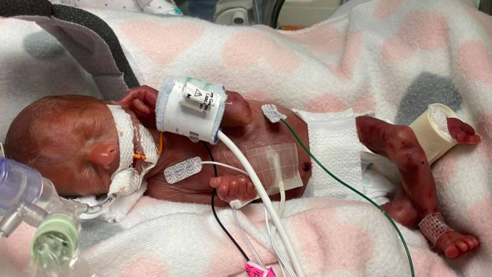 Volunteer Firefighter Saves Preemie’s Life After Mom Gives Birth At 24 ...