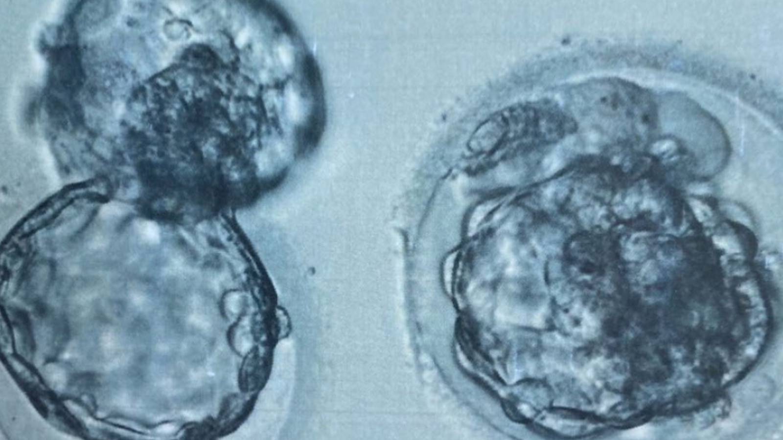 Frozen Embryo Transfers Linked To High Blood Pressure During Pregnancy